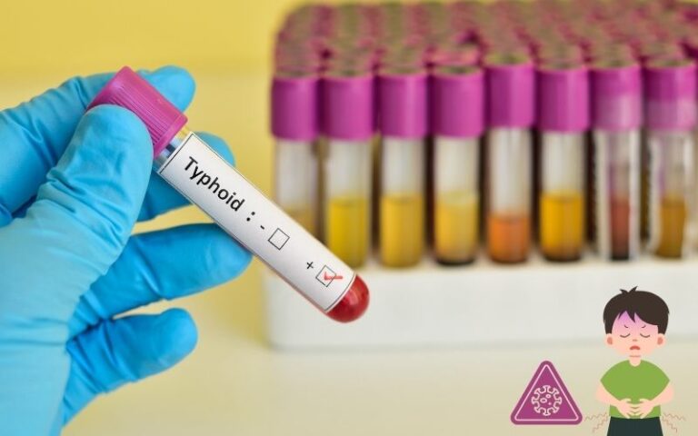 Is Typhoid contagious? Typhoid Specialist in Delhi NCR explains - My ...